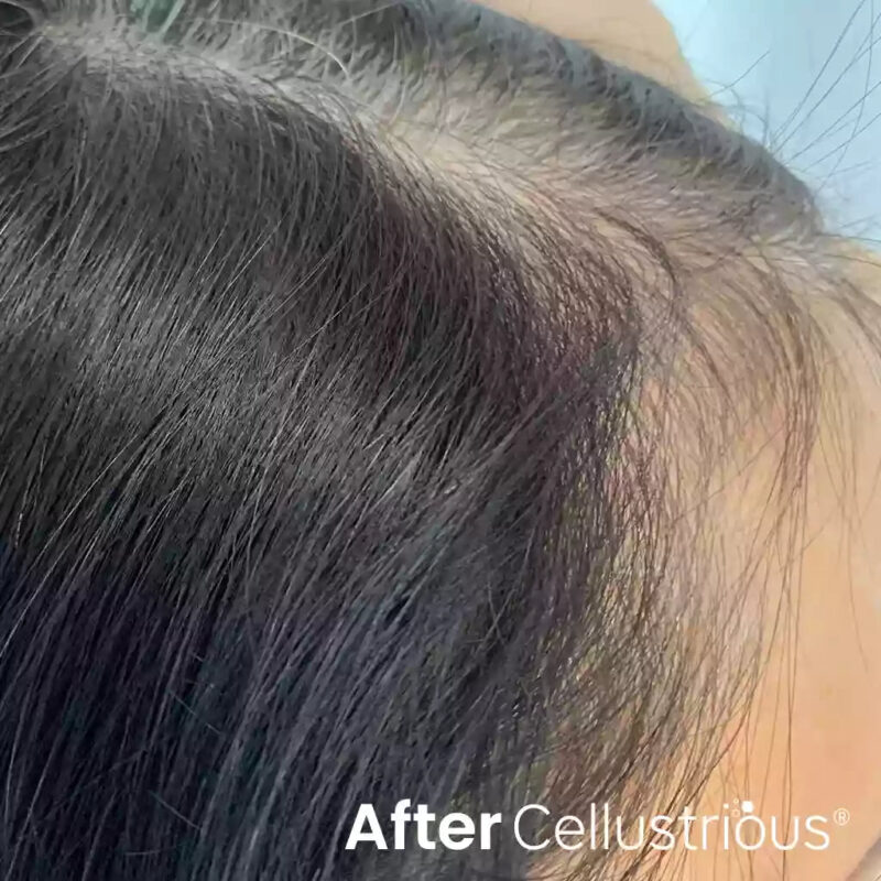Hair Loss Solutions Scottsdale Arizona - Cellustrious